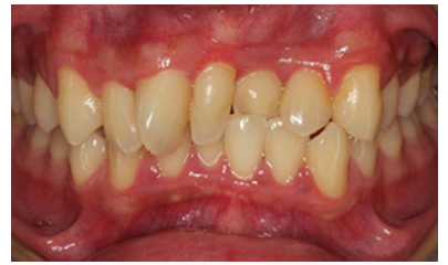 Before & After | Twaddle Orthodontics Columbia, MO