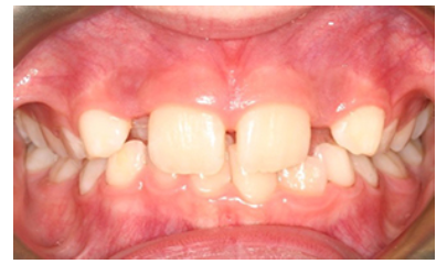 Before & After | Twaddle Orthodontics Columbia, MO